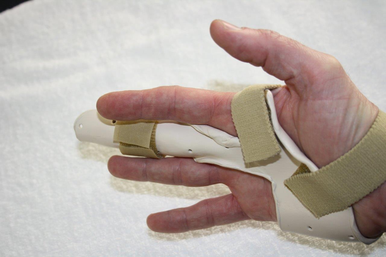 Okanagan Hand and Upper Limb Rehab – Certified Hand Therapists Using A ...